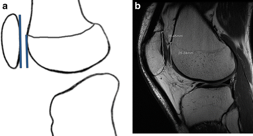 Transient lateral patellar dislocation: review of imaging findings ...