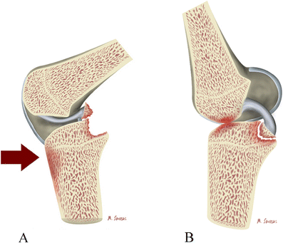 Cruciate ligament avulsion fractures: Anatomy, biomechanics, injury ...