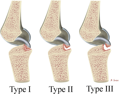 Cruciate ligament avulsion fractures: Anatomy, biomechanics, injury ...