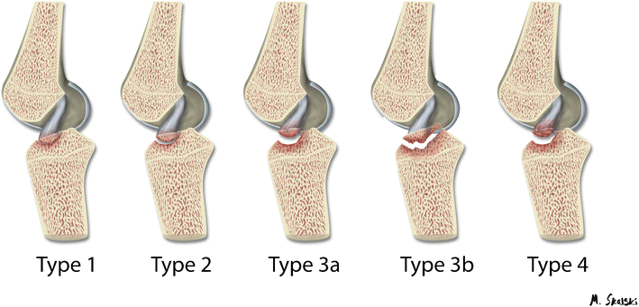 Cruciate ligament avulsion fractures: Anatomy, biomechanics, injury ...