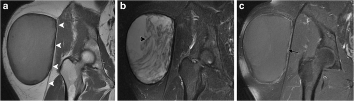 The Morel-Lavallée lesion: pathophysiology, clinical presentation ...
