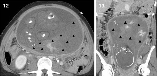 Traumatic Abruptio Placenta Scale (TAPS): a proposed grading system of ...