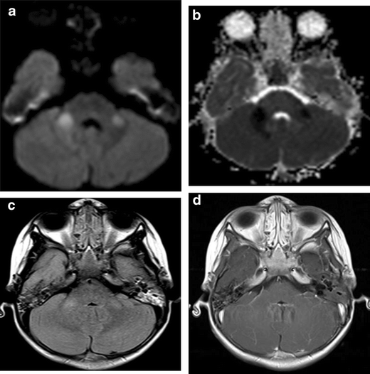 Reversible diffusion restriction of the middle cerebellar peduncles and ...