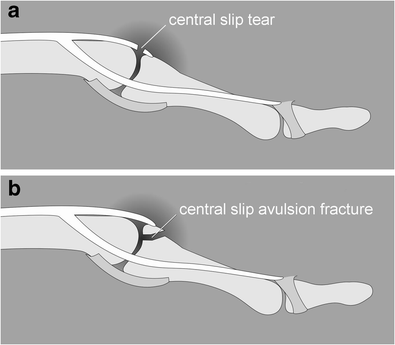 Pediatric hand injuries: essentials you need to know | SpringerLink