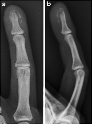 Pediatric hand injuries: essentials you need to know | SpringerLink