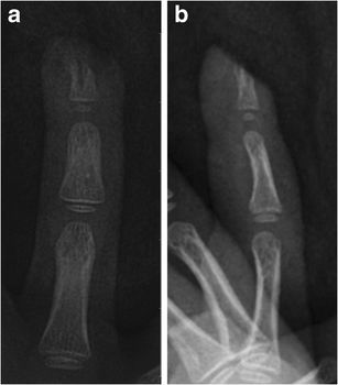 Pediatric hand injuries: essentials you need to know | SpringerLink