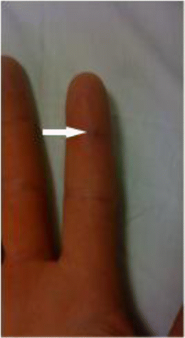 High-pressure paint gun injury: clinical presentation and imaging ...