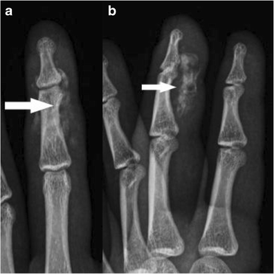 High-pressure paint gun injury: clinical presentation and imaging ...
