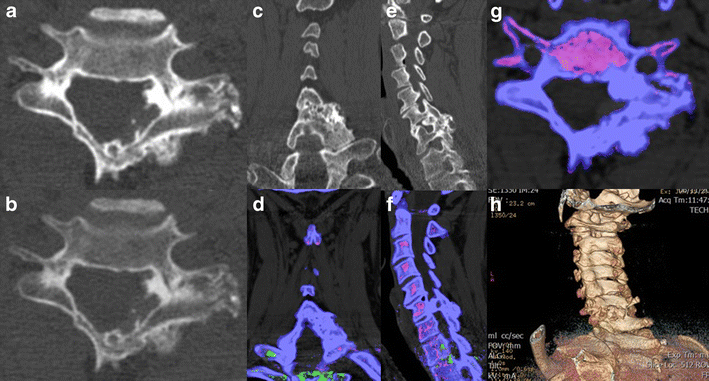 Dual-energy computed tomography (DECT) in emergency radiology: basic ...