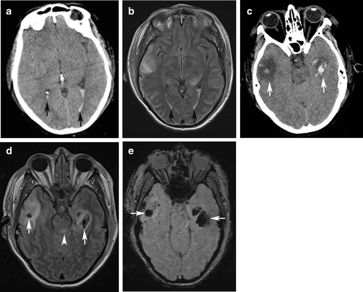 Magnetic resonance imaging of traumatic brain injury: a pictorial ...