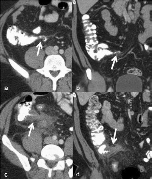 Stump appendicitis: surgical background, CT appearance, and imaging ...