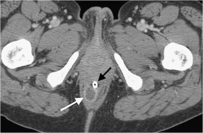 CT of acute perianal abscesses and infected fistulae: a pictorial essay ...