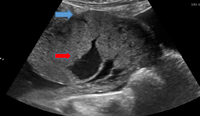 Sonography of placental abnormalities: a pictorial review | SpringerLink
