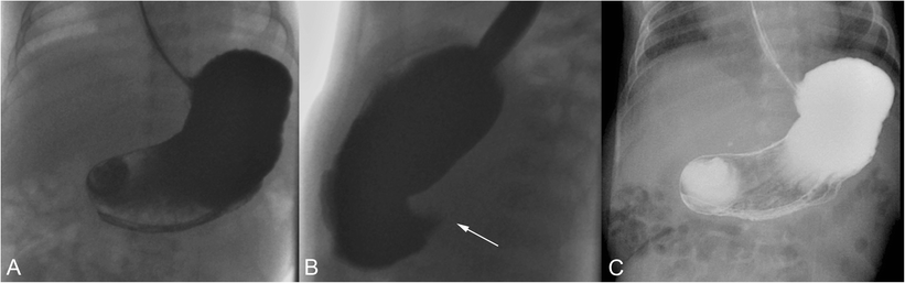 Imaging findings in infants with recurrent vomiting after pyloromyotomy ...