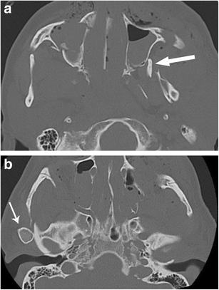 Fractures of the posterolateral maxillary sinus: a masticator space ...
