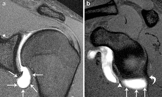 Inferior glenohumeral ligament (IGHL) complex: anatomy, injuries ...