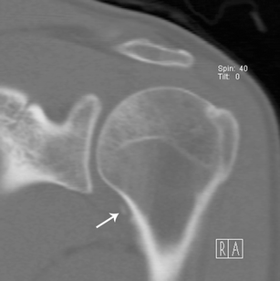 Inferior glenohumeral ligament (IGHL) complex: anatomy, injuries ...