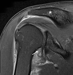 Inferior glenohumeral ligament (IGHL) complex: anatomy, injuries ...