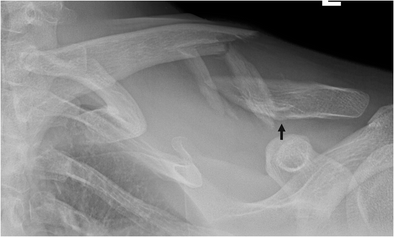 Distal clavicle fracture radiography and treatment: a pictorial essay ...
