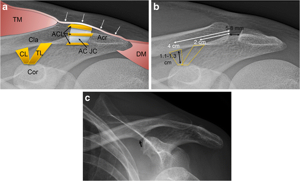 Distal clavicle fracture radiography and treatment: a pictorial essay ...