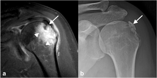 Isolated greater tuberosity fractures of the proximal humerus: anatomy ...