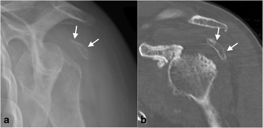 Isolated greater tuberosity fractures of the proximal humerus: anatomy ...