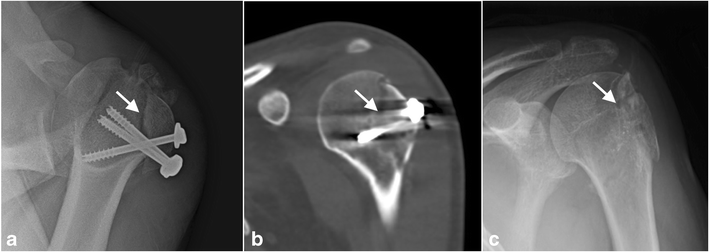 Isolated greater tuberosity fractures of the proximal humerus: anatomy ...