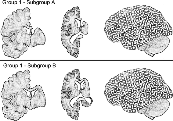 Hemispherectomy: a schematic review of the current techniques ...