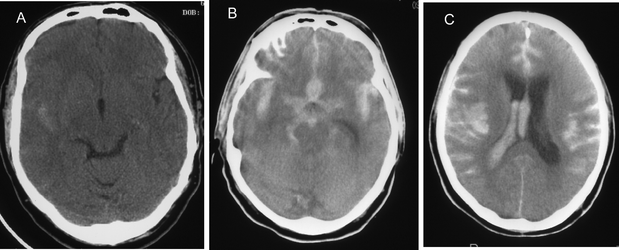 Management of cerebral vasospasm | SpringerLink