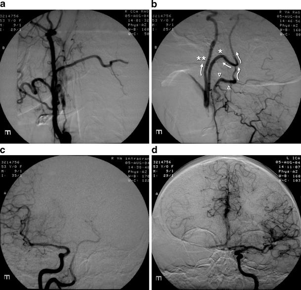Persistent primitive hypoglossal artery with retrograde flow from the ...
