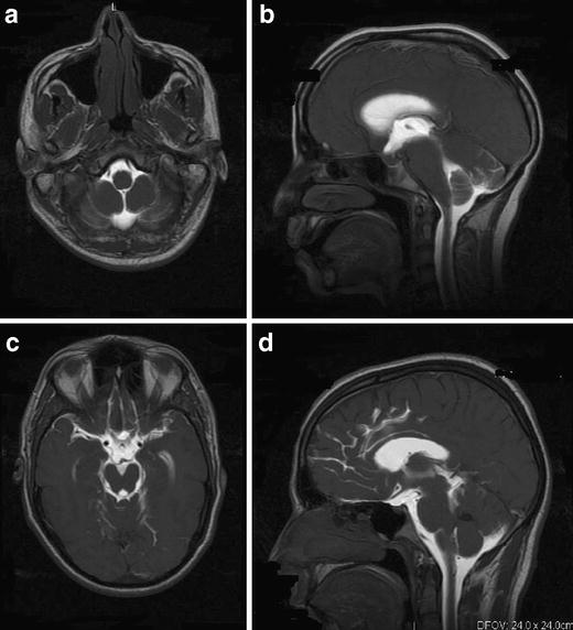 Role of endoscopic third ventriculostomy in patients with communicating ...