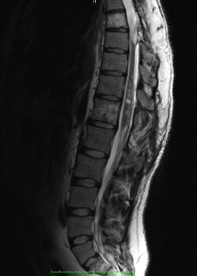 Intramedullary lesions of the conus medullaris: differential diagnosis ...