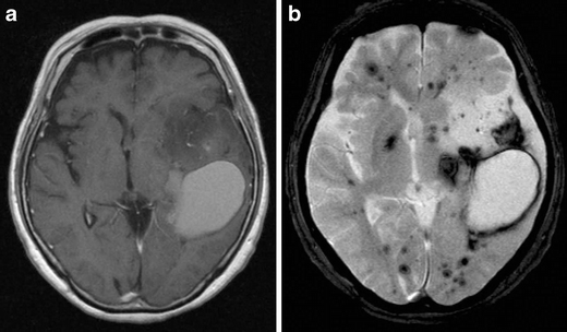 Cystic cavernous angiomas | SpringerLink