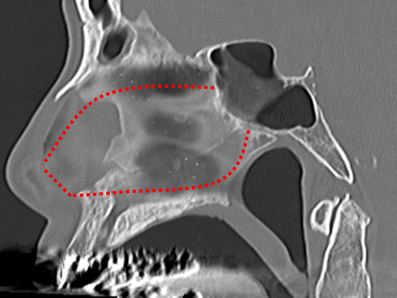 Endoscopic endonasal skull base reconstruction using a nasal septal flap: surgical results and ...