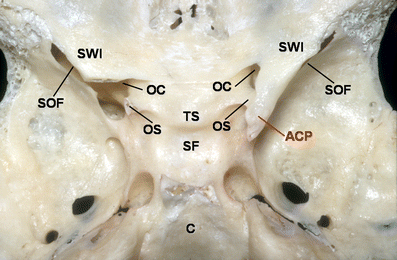 Pneumatization degree of the anterior clinoid process: a new ...