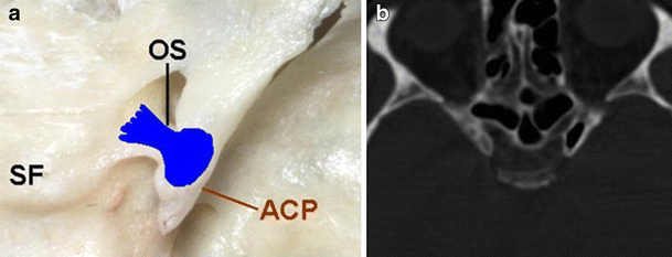 Pneumatization degree of the anterior clinoid process: a new ...