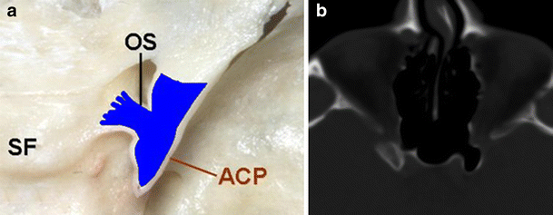 Pneumatization degree of the anterior clinoid process: a new ...