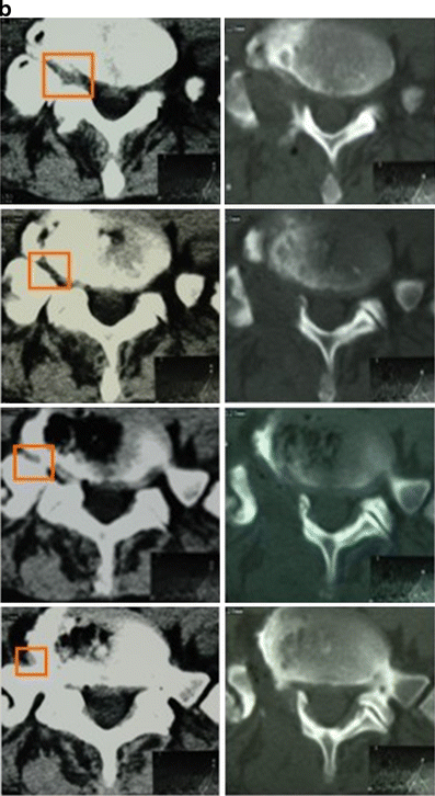 Transitional lumbosacral segment with unilateral transverse process ...