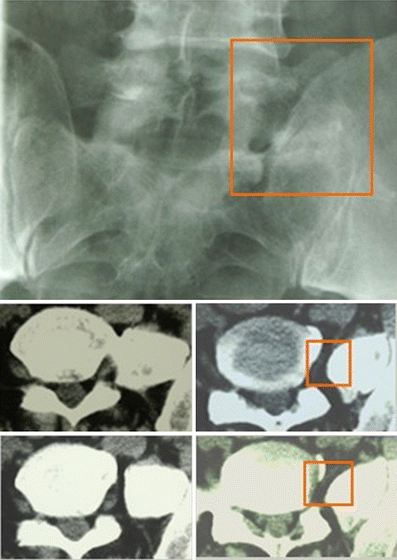 Transitional lumbosacral segment with unilateral transverse process ...