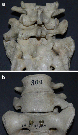 Transitional lumbosacral segment with unilateral transverse process ...