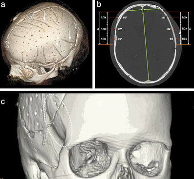 Intraoperative template-molded bone flap reconstruction for patient ...