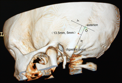 Localization of transverse-sigmoid sinus junction using preoperative 3D ...