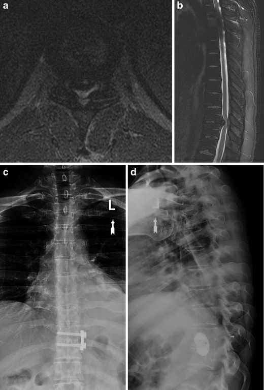 Surgical treatment of thoracic disc disease via minimally invasive ...