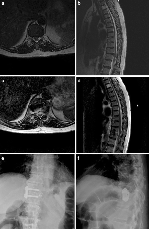 Surgical treatment of thoracic disc disease via minimally invasive ...