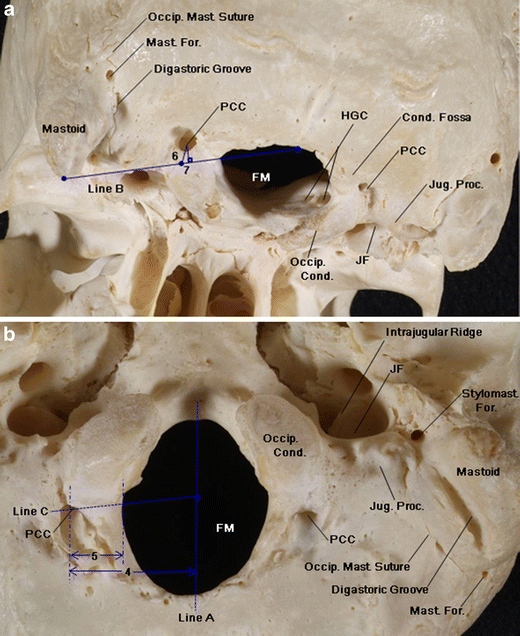 Posterior condylar canals and posterior condylar emissary veins—a ...