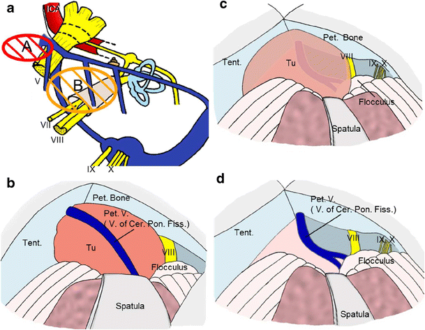 Anatomy of the superior petrosal veins and their exposure and ...