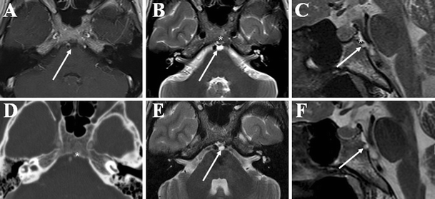 Ecchordosis physaliphora: typical and atypical radiologic features ...