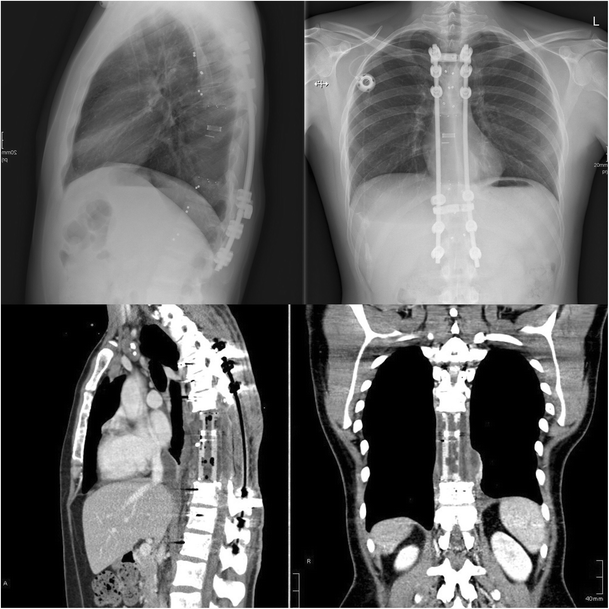 Thoracic corpectomy for neoplastic vertebral bodies using a navigated ...