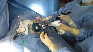 Single incision laparoscopic total abdominal colectomy with ileorectal ...