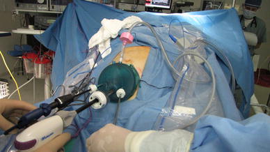 Single incision laparoscopic total abdominal colectomy with ileorectal ...